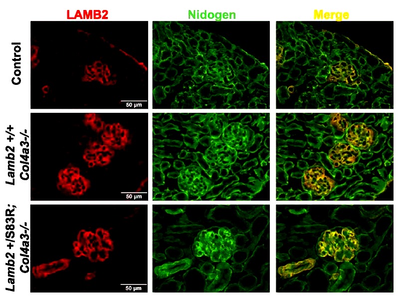 New Study Provides Insight for Variability in the Severity of Alport ...